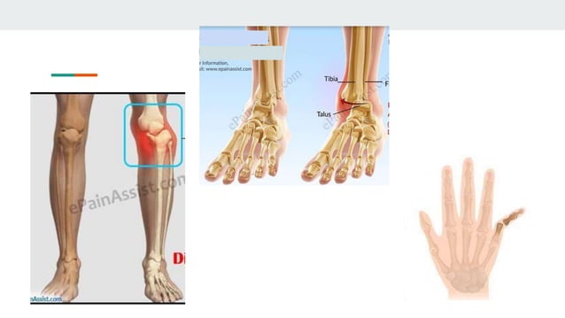 Common Injuries in the Skeletal System | PPT