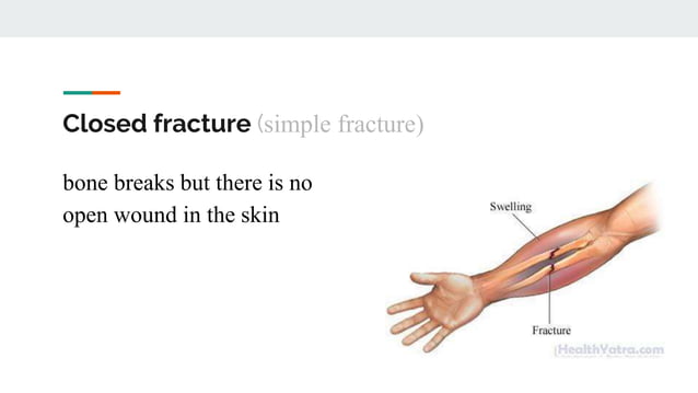 Common Injuries in the Skeletal System | PPT