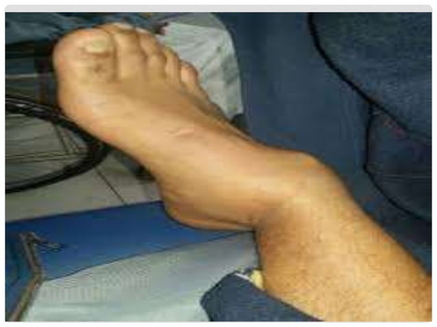 Common injuries involved in active recreation | PPT Common injuries involved in active recreation | PPT