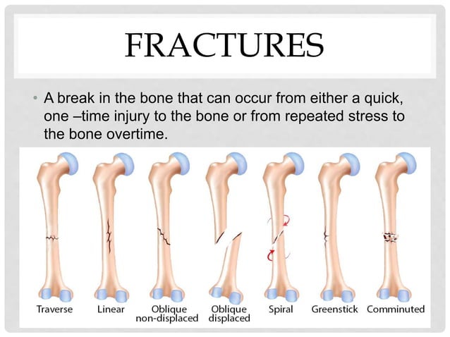 Common injuries involved in active recreation | PPT Common injuries involved in active recreation | PPT