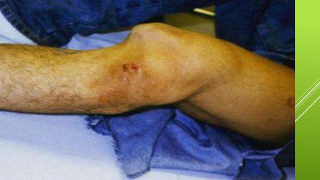 COMMON INJURIES INVOLVED IN ACTIVE RECREATIONAL ACTIVITIES.pptx COMMON INJURIES INVOLVED IN ACTIVE RECREATIONAL ACTIVITIES.pptx