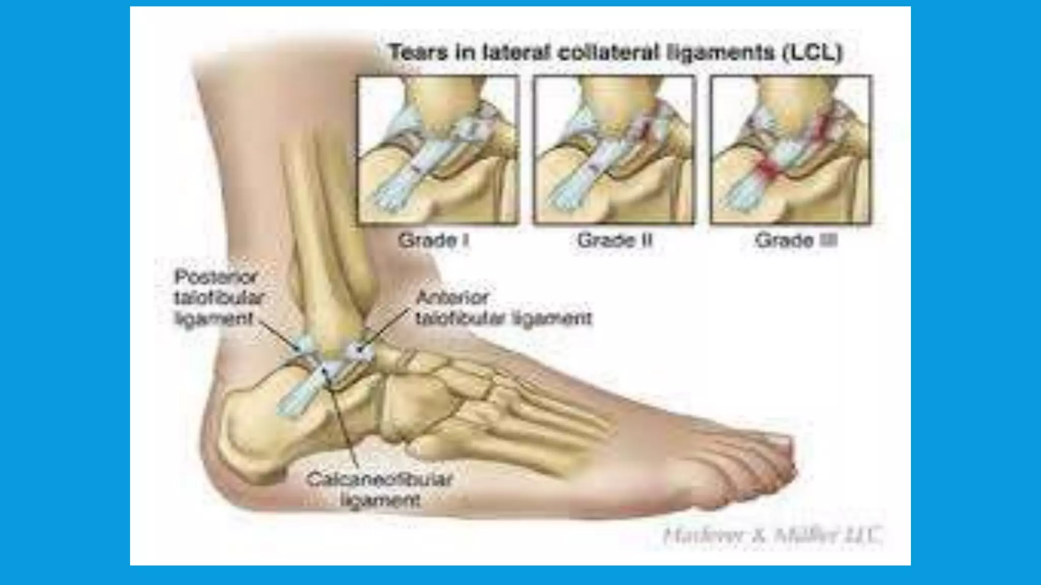 Common injuries of lower extremity | PPTX