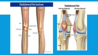 Common injuries of lower extremity | PPTX