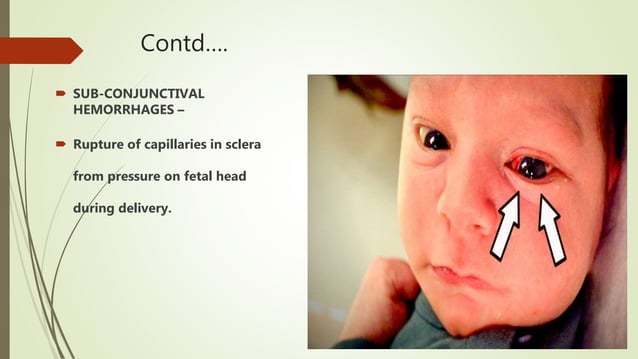 Common neonatal disorder BSC Nursing 3r year | PPTX