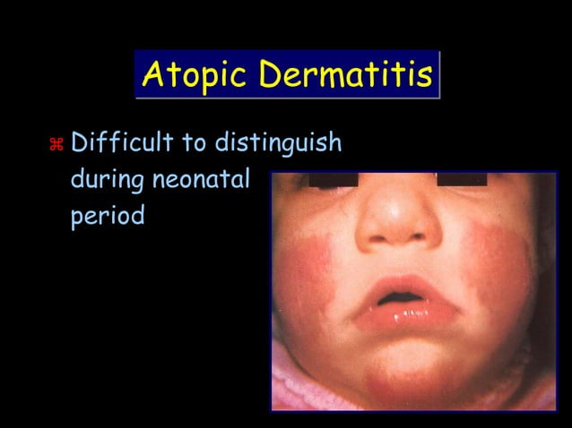 Common neonatal problems | PPT