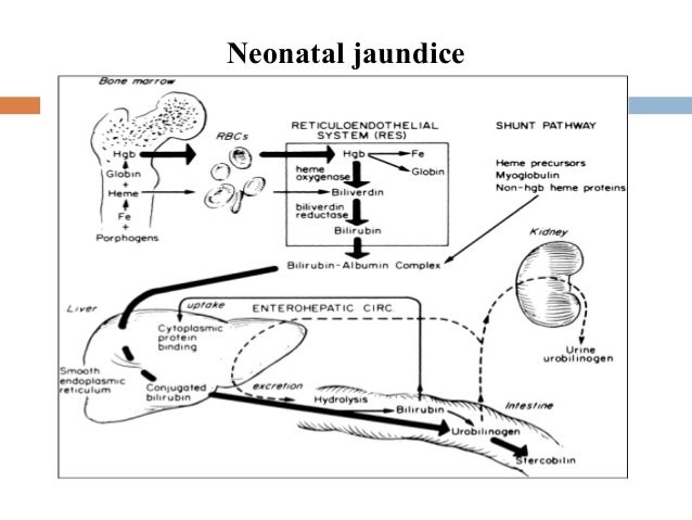 approach to the diagnosis of Neonatal jaundice
