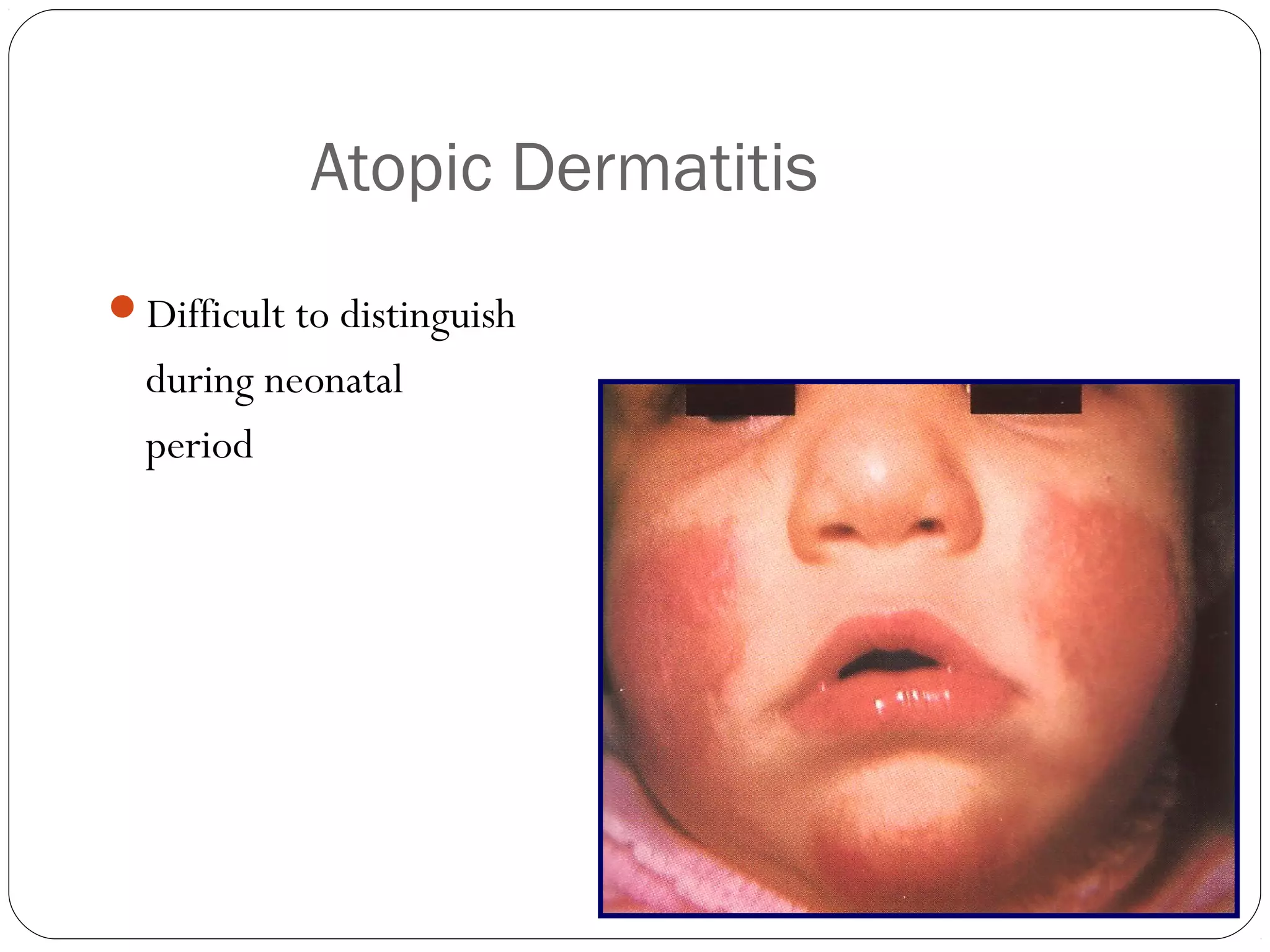 Common neonatal skin problems | PPT