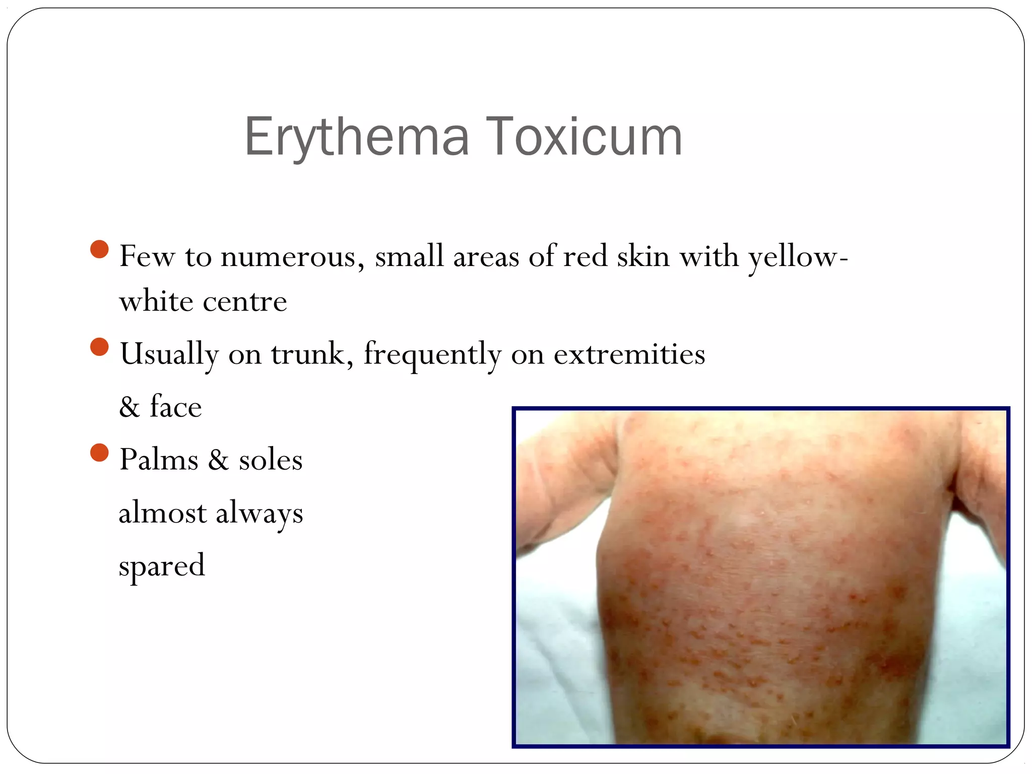 Common neonatal skin problems | PPT