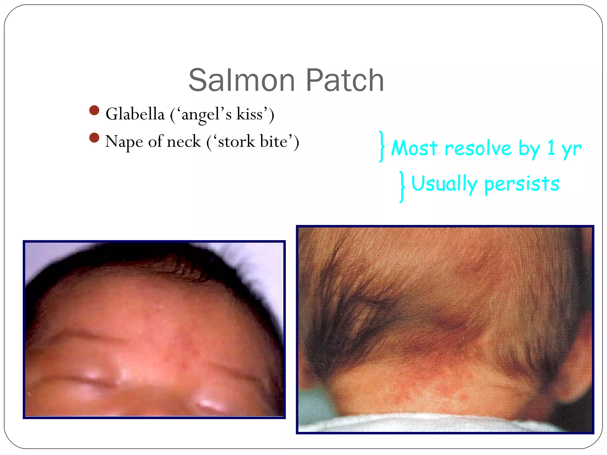 Common neonatal skin problems | PPT