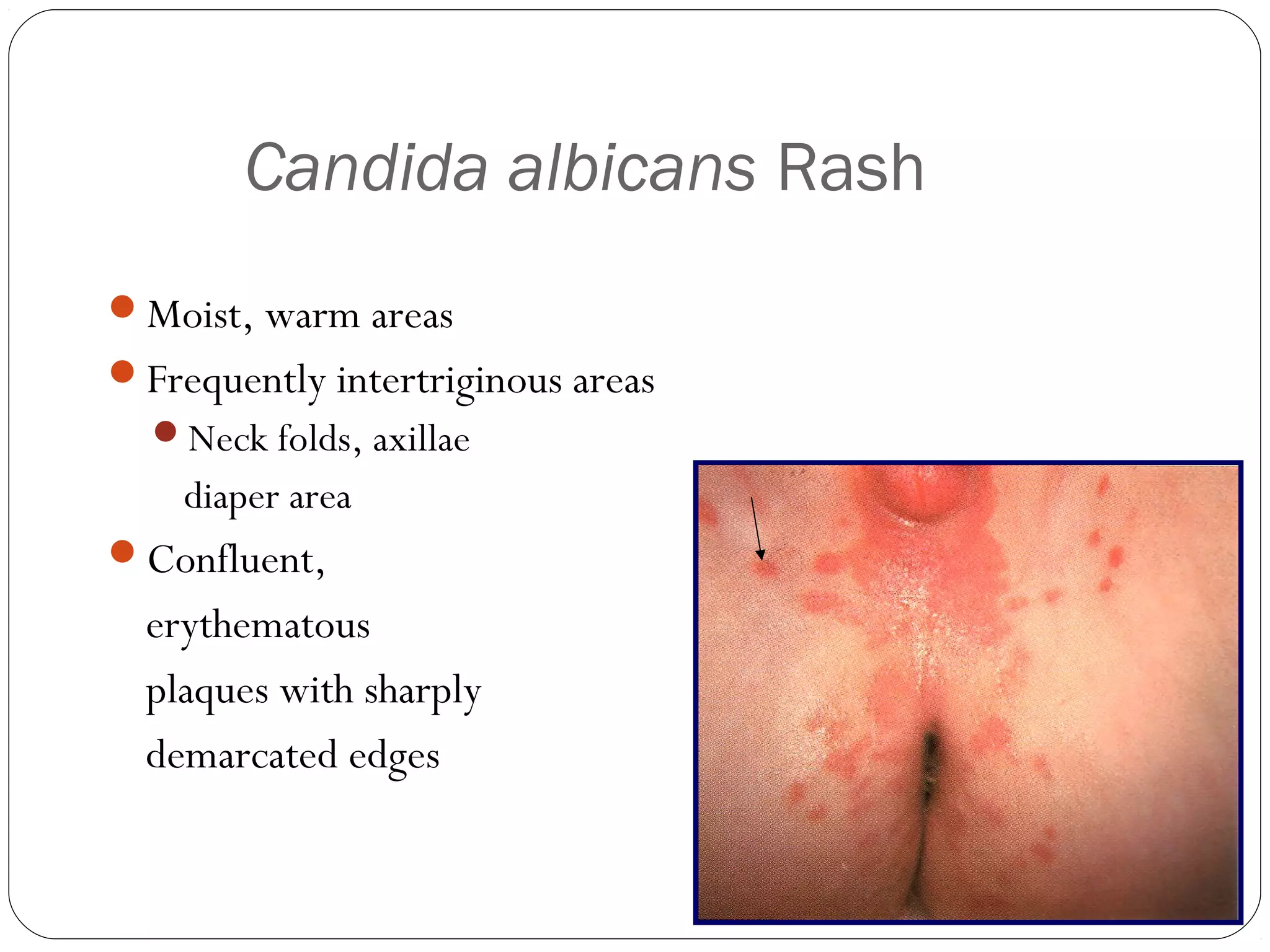 Common neonatal skin problems | PPT