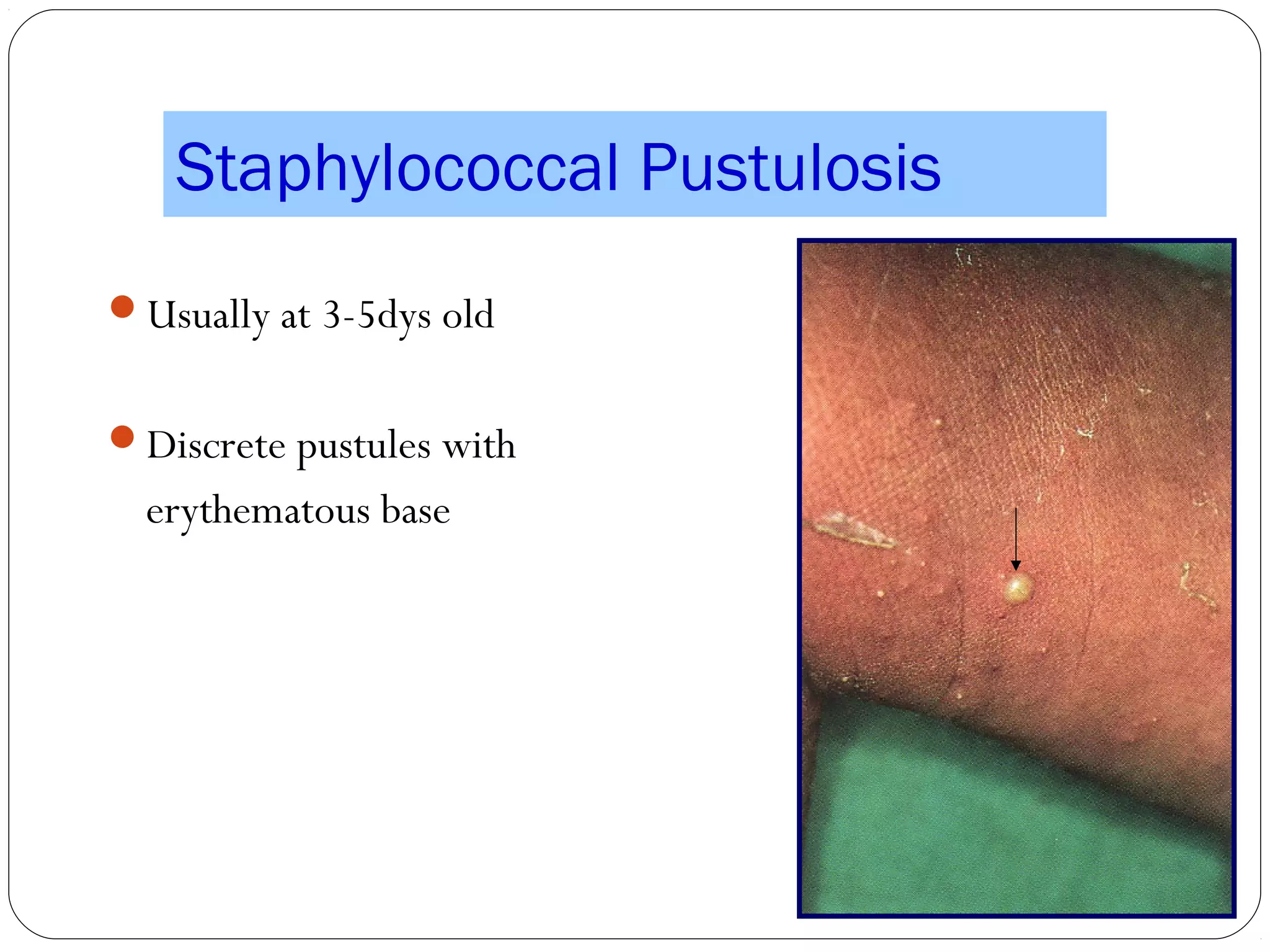 Common neonatal skin problems | PPT