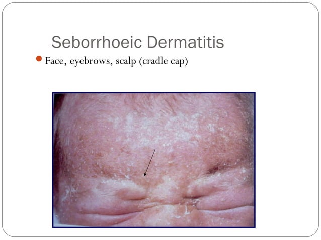 Common neonatal skin problems | PPT | Skin and Dermatology | Diseases ...