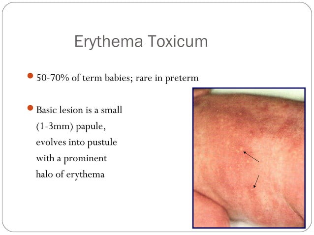 Common neonatal skin problems | PPT | Skin and Dermatology | Diseases ...