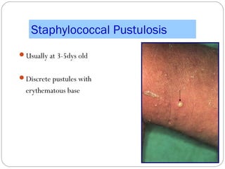 Common neonatal skin problems | PPT