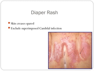Yeast Diaper Rash Satellite Lesions
