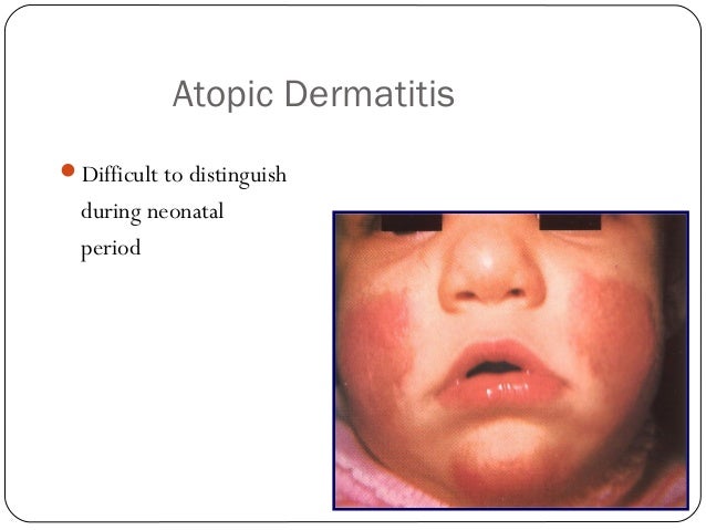 What Are The Most Common Neonatal Infections With Pictures 27 Common