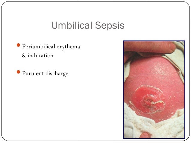 Umbilical Stump Bleeding