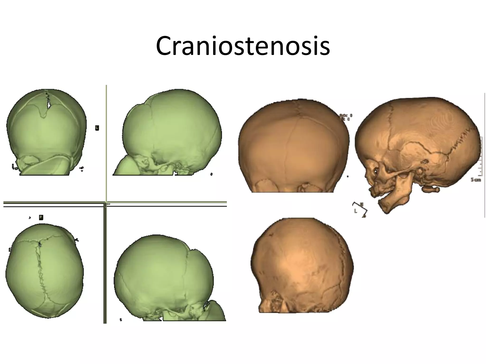 Common neurosurgical disorders in children | PPTX