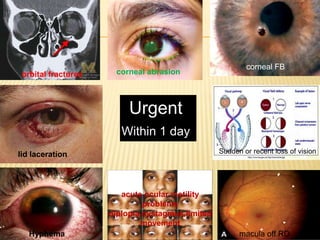 Common ocular emergencies | PPTX