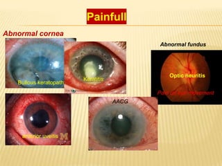 Common ocular emergencies | PPTX