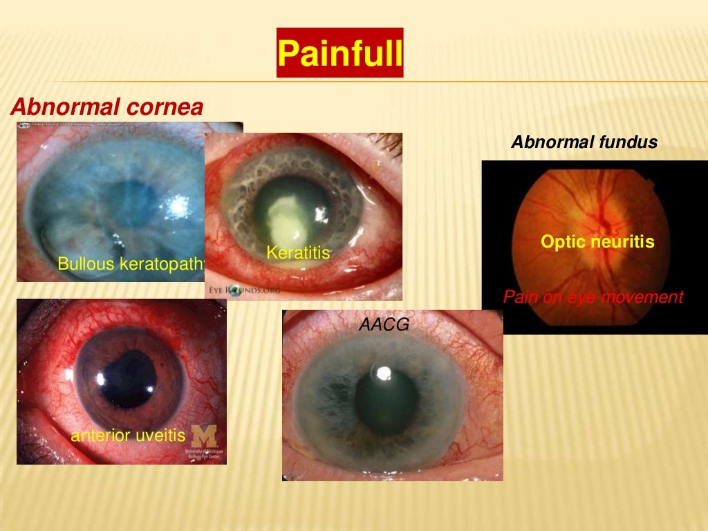 Common ocular emergencies