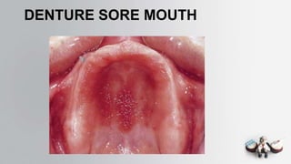 Common oral lesions2 | PPTX