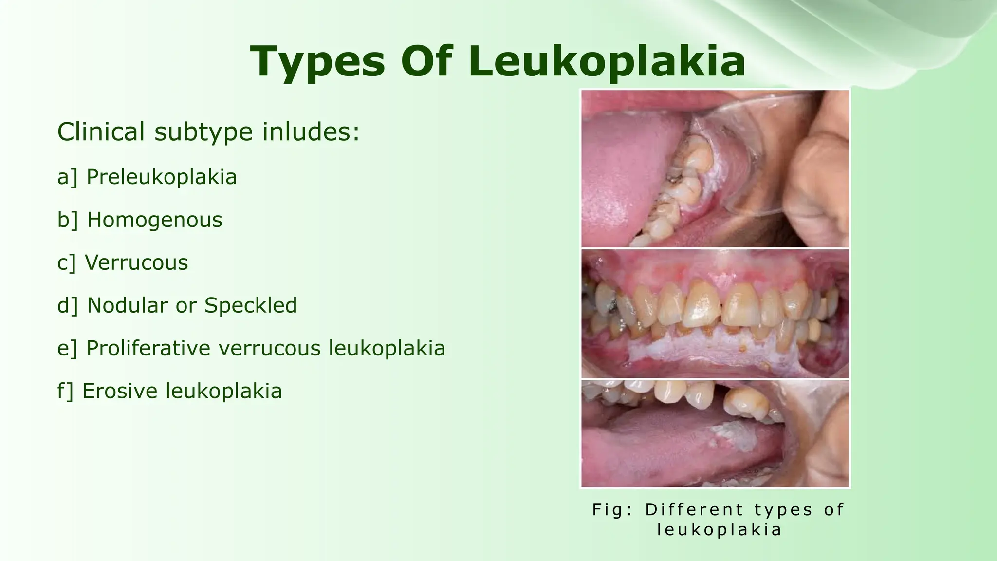 Common Oral Ulcer And Their Management By Stuti and Jasmin.pptx