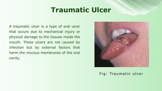 Common Oral Ulcer And Their Management By Stuti and Jasmin.pptx