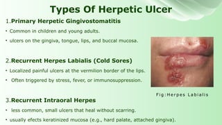 Common Oral Ulcer And Their Management By Stuti and Jasmin.pptx