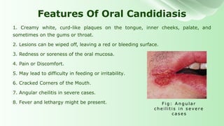 Common Oral Ulcer And Their Management By Stuti and Jasmin.pptx