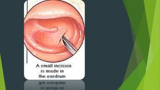 Myringotomy | PPTX