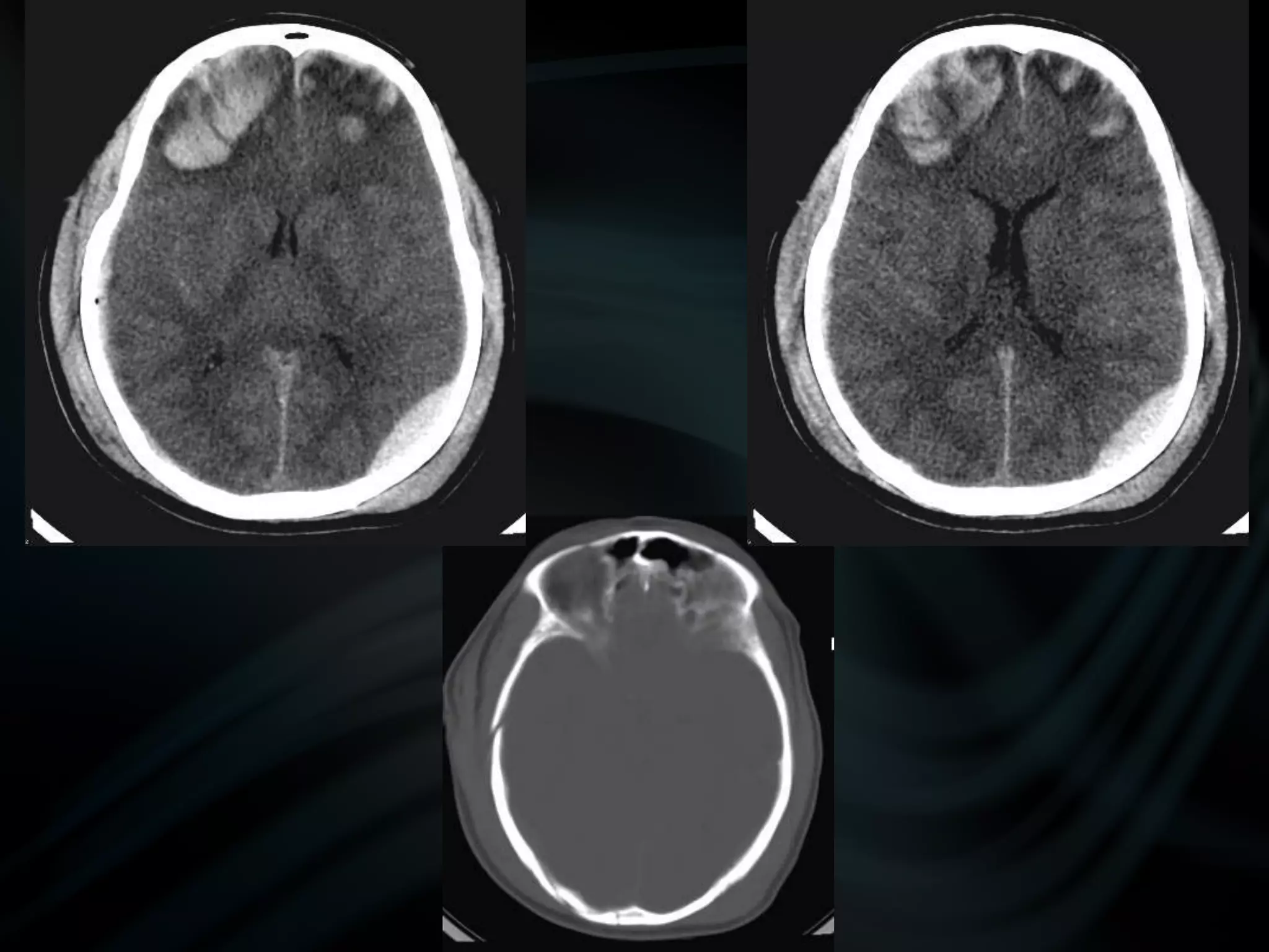 common pathologies of brain.pptx
