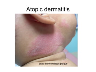 Common Pediatrics Rashes.ppt well explained pictutes | PPT