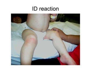 Common Pediatrics Rashes.ppt well explained pictutes | PPT