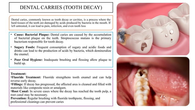 Common problems associated with oral cavities.pptx | Dental Health ...