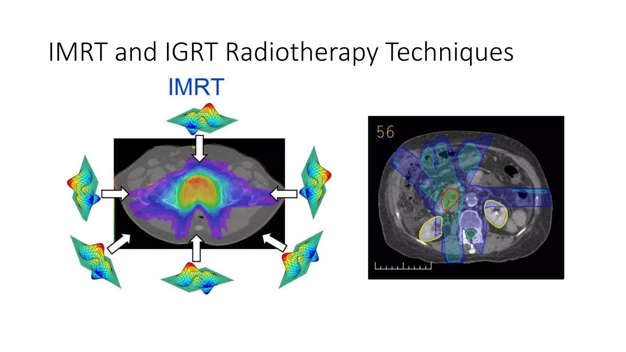 Common Radiation Therapy Facts and Myths.pptx