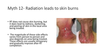 Common Radiation Therapy Facts and Myths.pptx