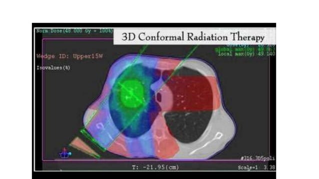 Common Radiation Therapy Facts and Myths.pptx | Cancer | Diseases and ...