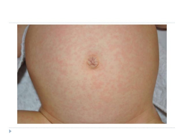 Common rashes in childhood