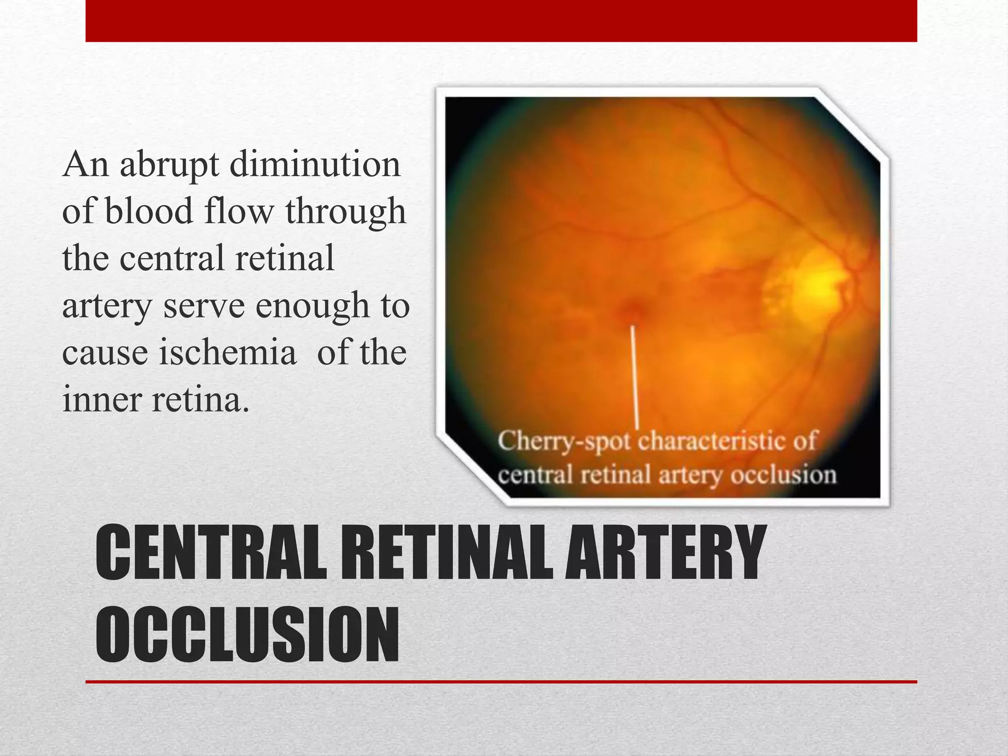 Common retinal disease | PPTX