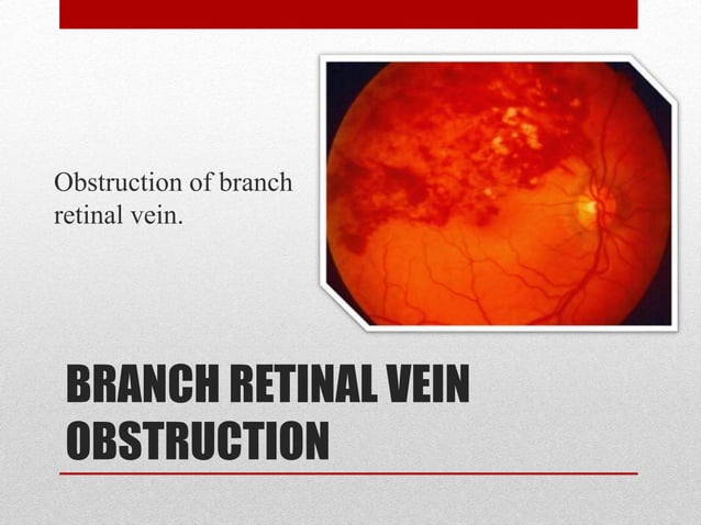 Common retinal disease | PPTX | Eye and Vision Conditions | Diseases ...