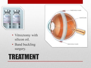 Common retinal disease | PPTX