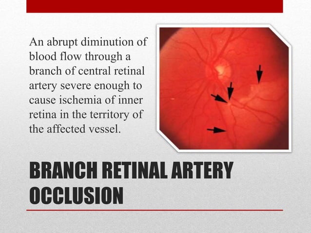 Common retinal disease | PPTX | Eye and Vision Conditions | Diseases ...