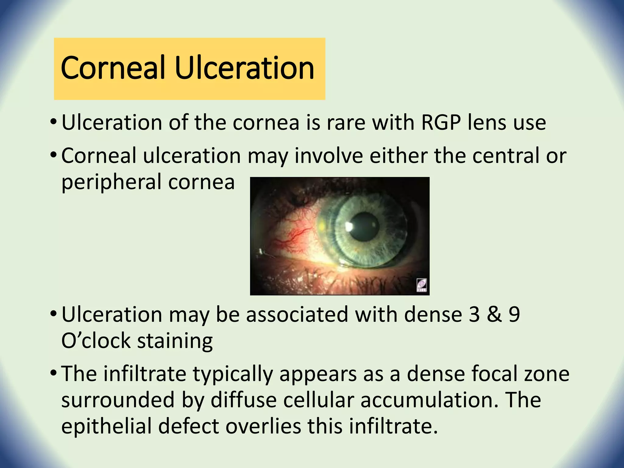 RGP Complications | PPTX