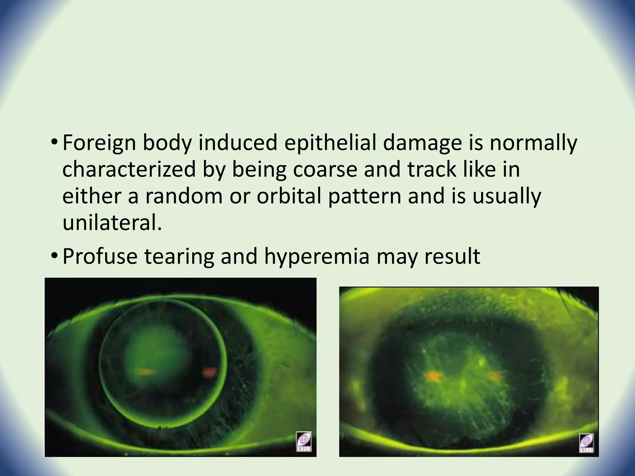 RGP Complications | PPTX | Eye and Vision Conditions | Diseases and Conditions