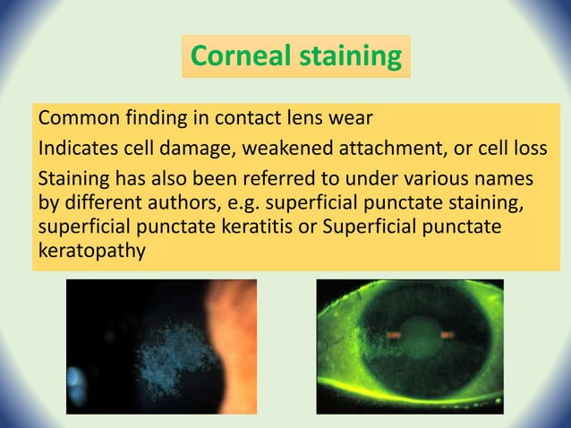 RGP Complications | PPTX | Eye and Vision Conditions | Diseases and Conditions
