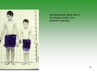 Common Rheumatic Disease In Children Ppt