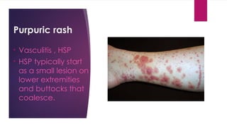 Common Rheumatological Disorders medicine.pptx