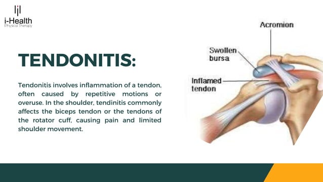 common shoulder complex disorders.pptx