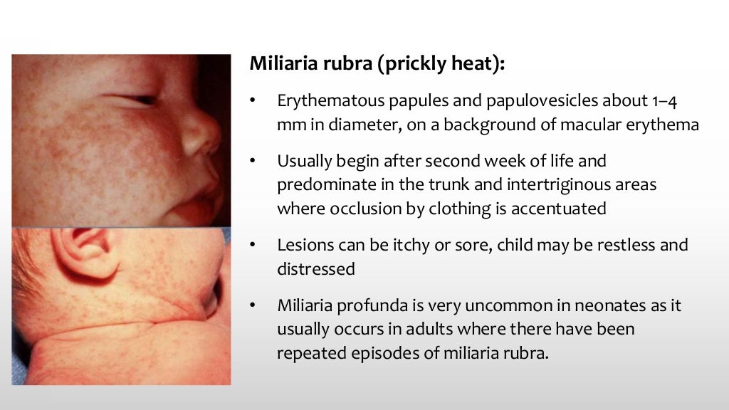 Common skin conditions in neonates
